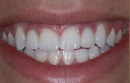 Before & After Results | Baton Rouge, LA | Barksdale Dentistry