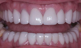 Before & After Results | Baton Rouge, LA | Barksdale Dentistry